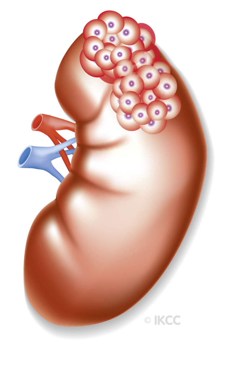 What is Kidney Cancer? - IKCC - International Kidney Cancer Coalition